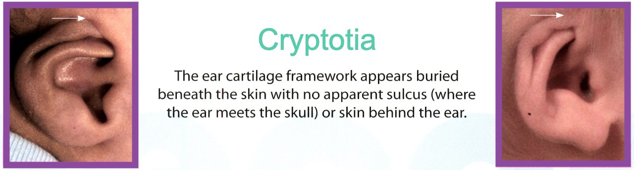 Cryptotia Ear Deformity | Ears R Us