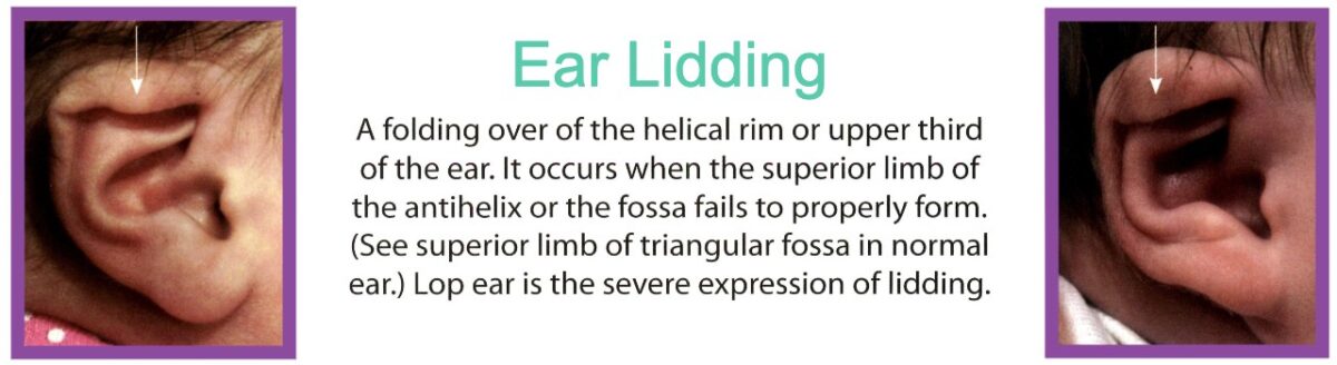 Ear Lidding Treatment | Ears R Us