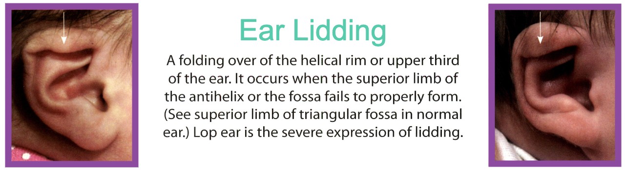 Ear Lidding Treatment | Ears R Us