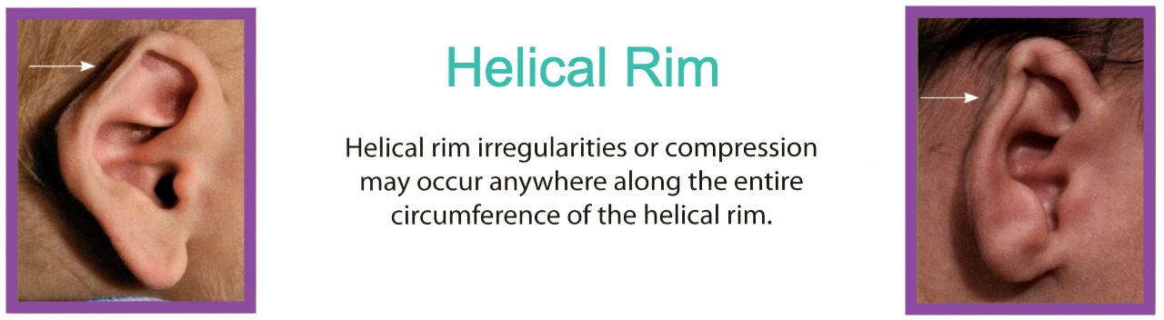 Helical Rim Deformity | Ears R Us