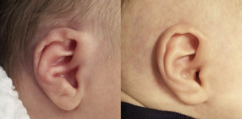 Helical Rim Deformity | Ears R Us