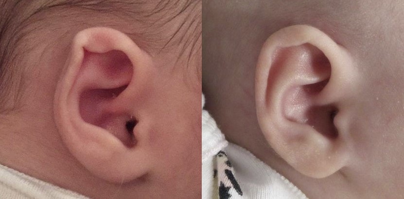 Helical Rim Deformity | Ears R Us