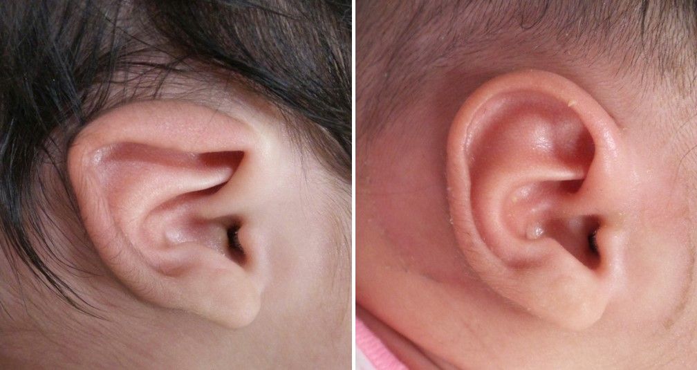 Ear Lidding Treatment | Ears R Us