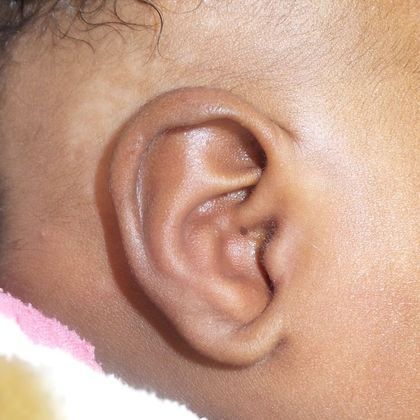 Inverted Conchal Bowl Deformity | NYC and Trumbull, CT | Ears R Us