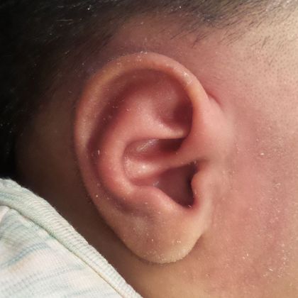 Flat Helix Ear Deformity | Ears R Us