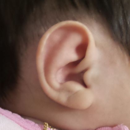 Flat Helix Ear Deformity | Ears R Us